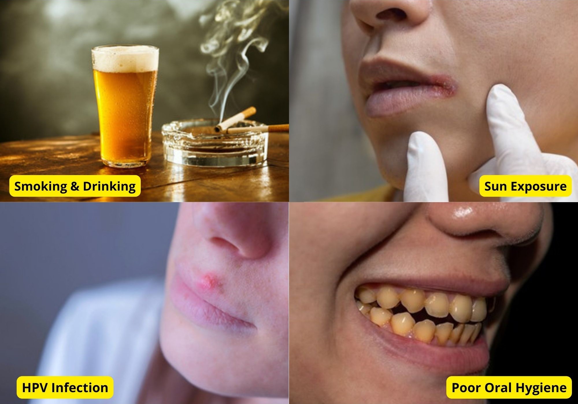 5 Common Symptoms of Lip Cancer: Its Causes & Treatments - Summirow
